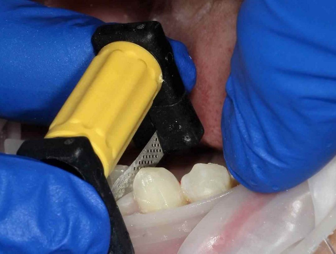 Interproximal Reduction Just Got More Predictable using FitStrips by ...